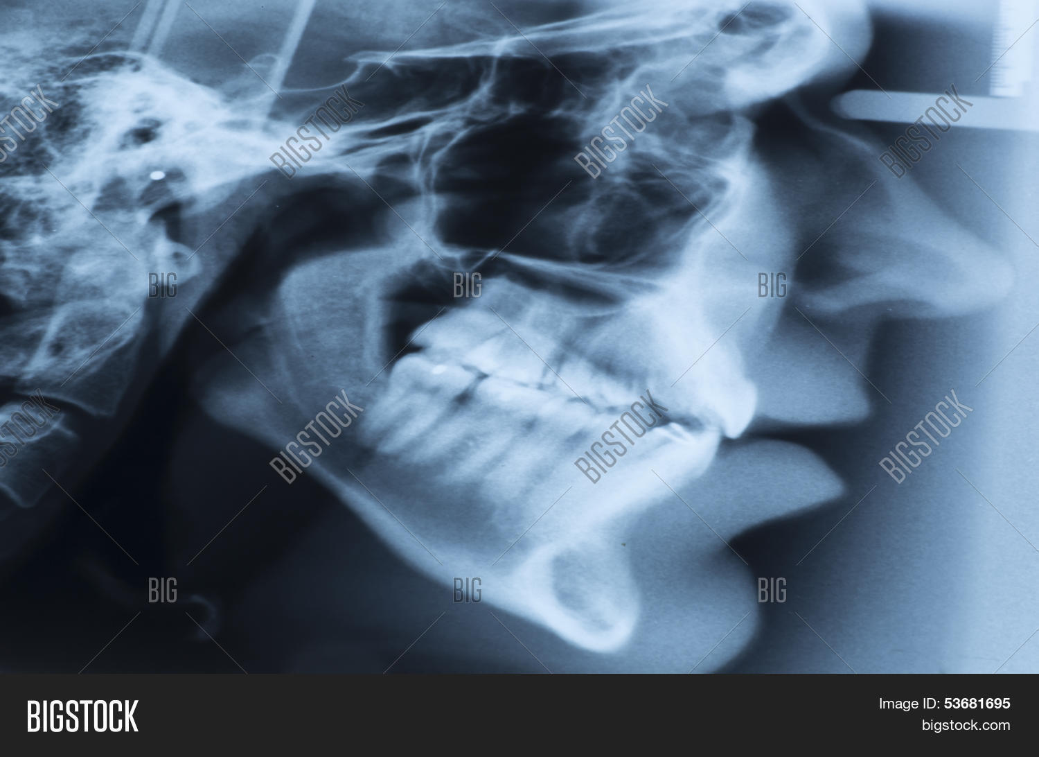 Lateral Cephalometric Image & Photo (Free Trial) | Bigstock