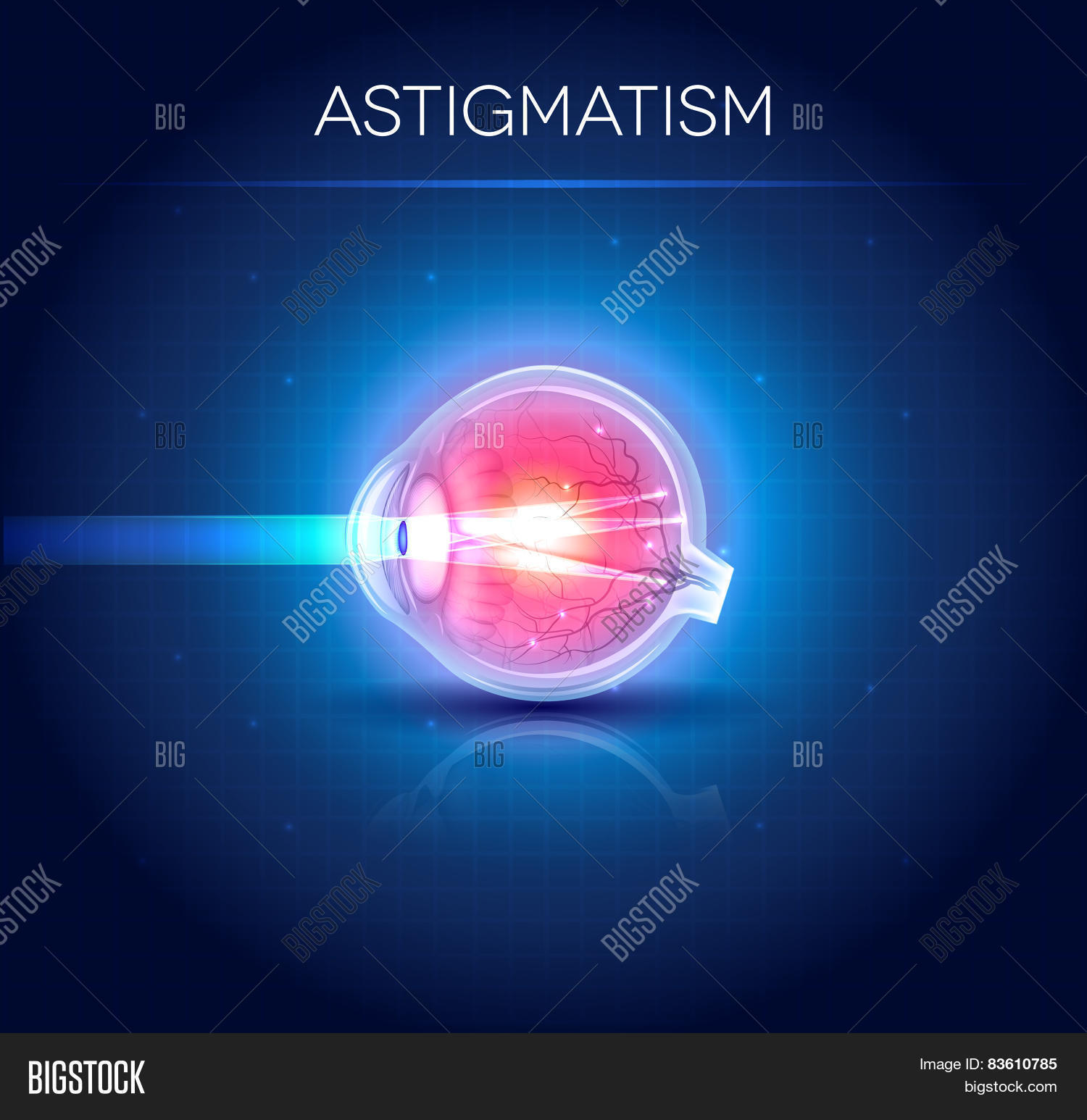 Astigmatism Eyesight Vector & Photo (Free Trial) | Bigstock
