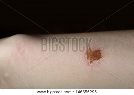 Crust Scratch Wound On Image & Photo (Free Trial) | Bigstock