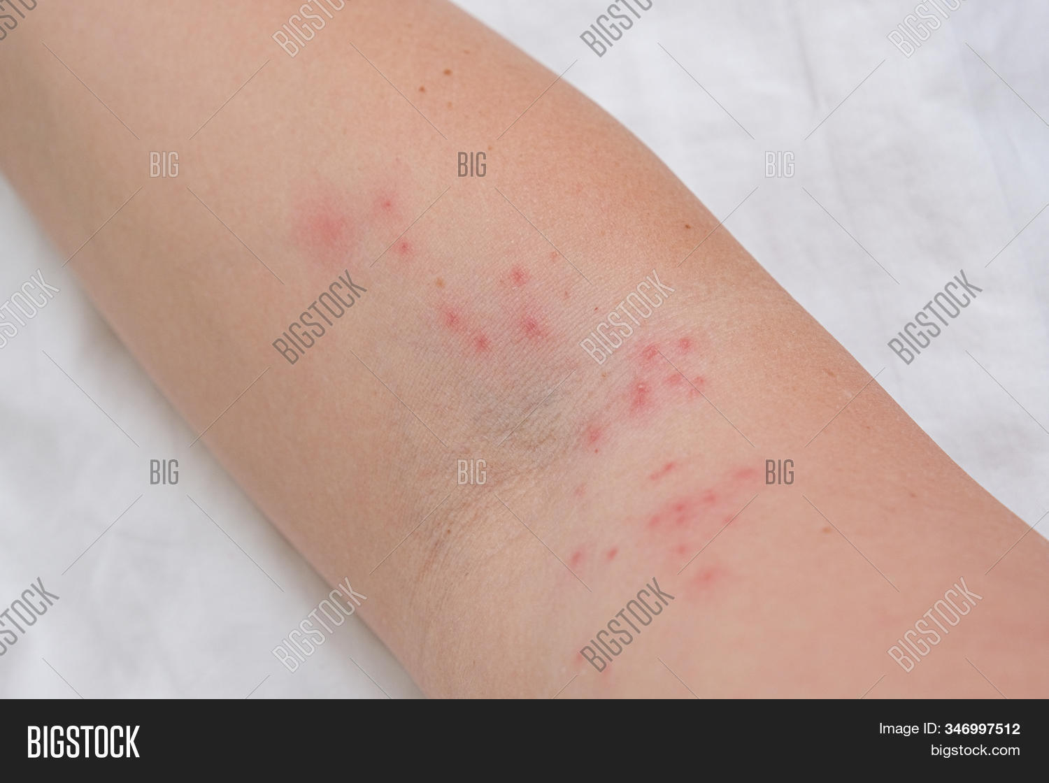Skin Rash On Female Image & Photo (Free Trial) | Bigstock