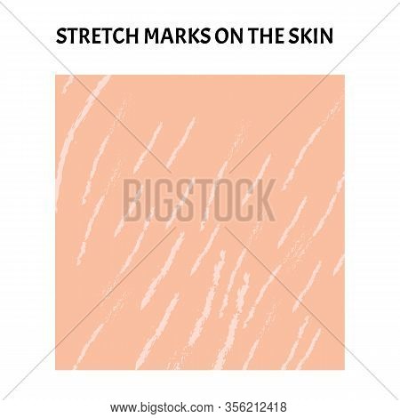 Stretch Marks On Skin Vector & Photo (Free Trial) | Bigstock