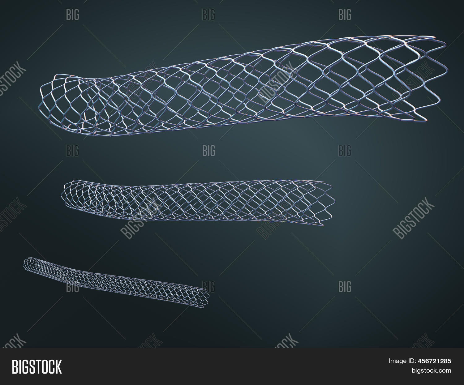 Three Metal Stents Image & Photo (Free Trial) | Bigstock
