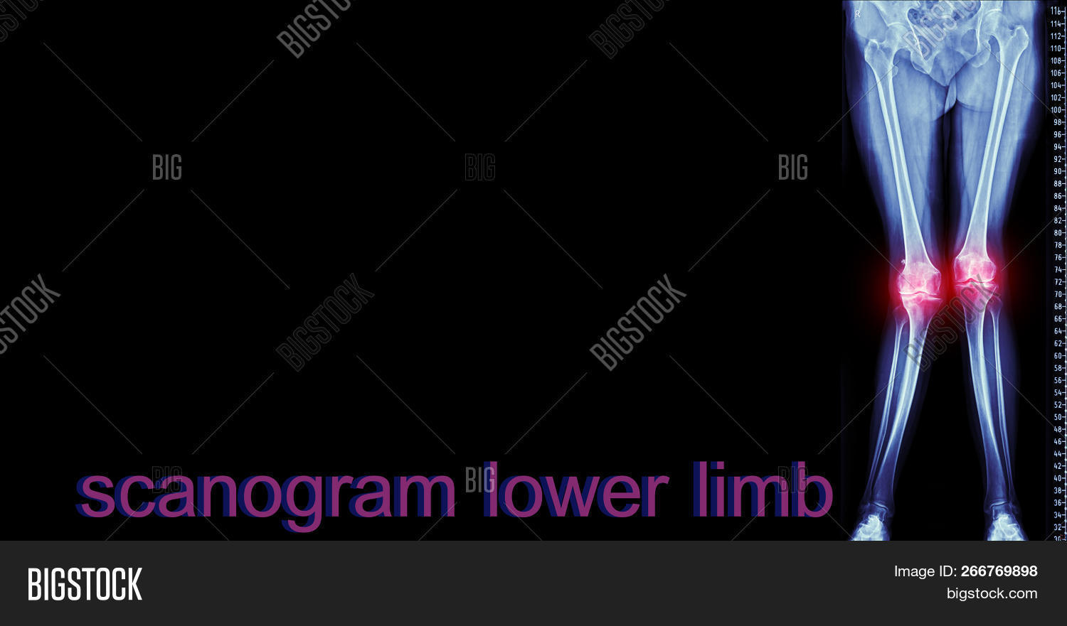 Scanogram X-ray Image Image & Photo (Free Trial) | Bigstock