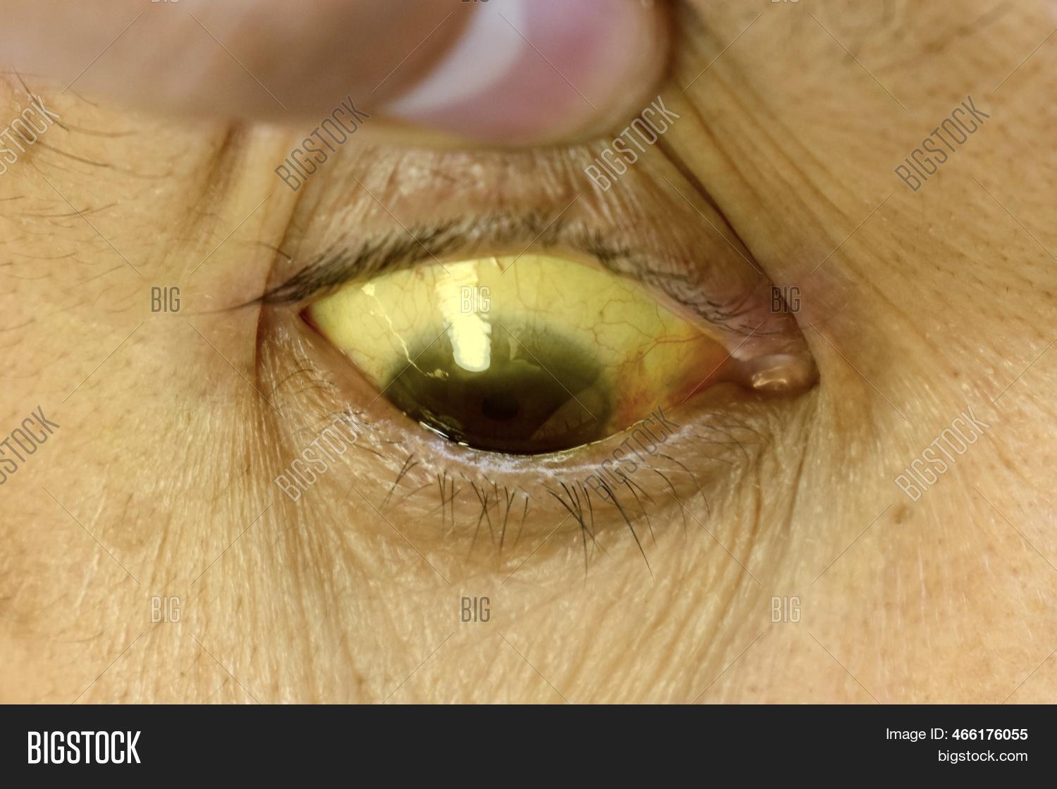 Deep Jaundice Asian Image & Photo (Free Trial) | Bigstock