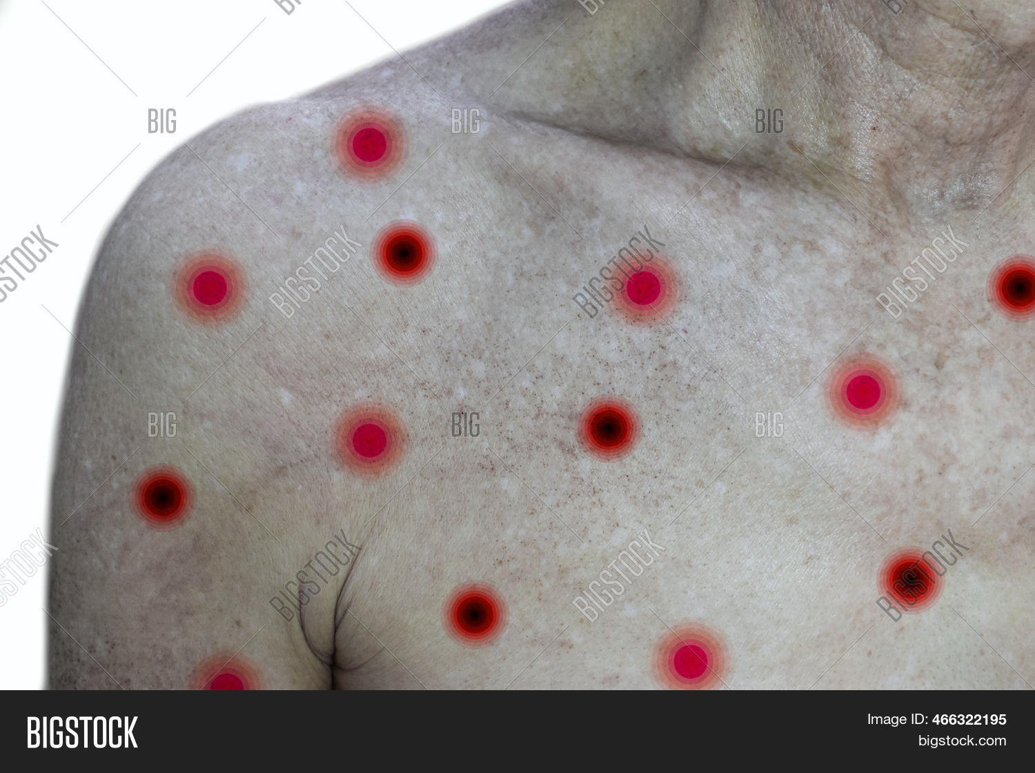 Monkeypox Skin Rashes Image & Photo (Free Trial) | Bigstock