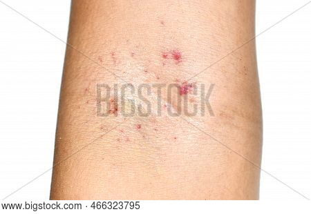 Multiple Red Spots Image & Photo (Free Trial) | Bigstock