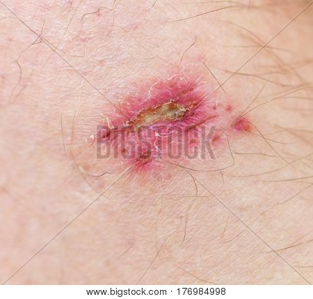 Close Shot Wound On Image & Photo (Free Trial) | Bigstock