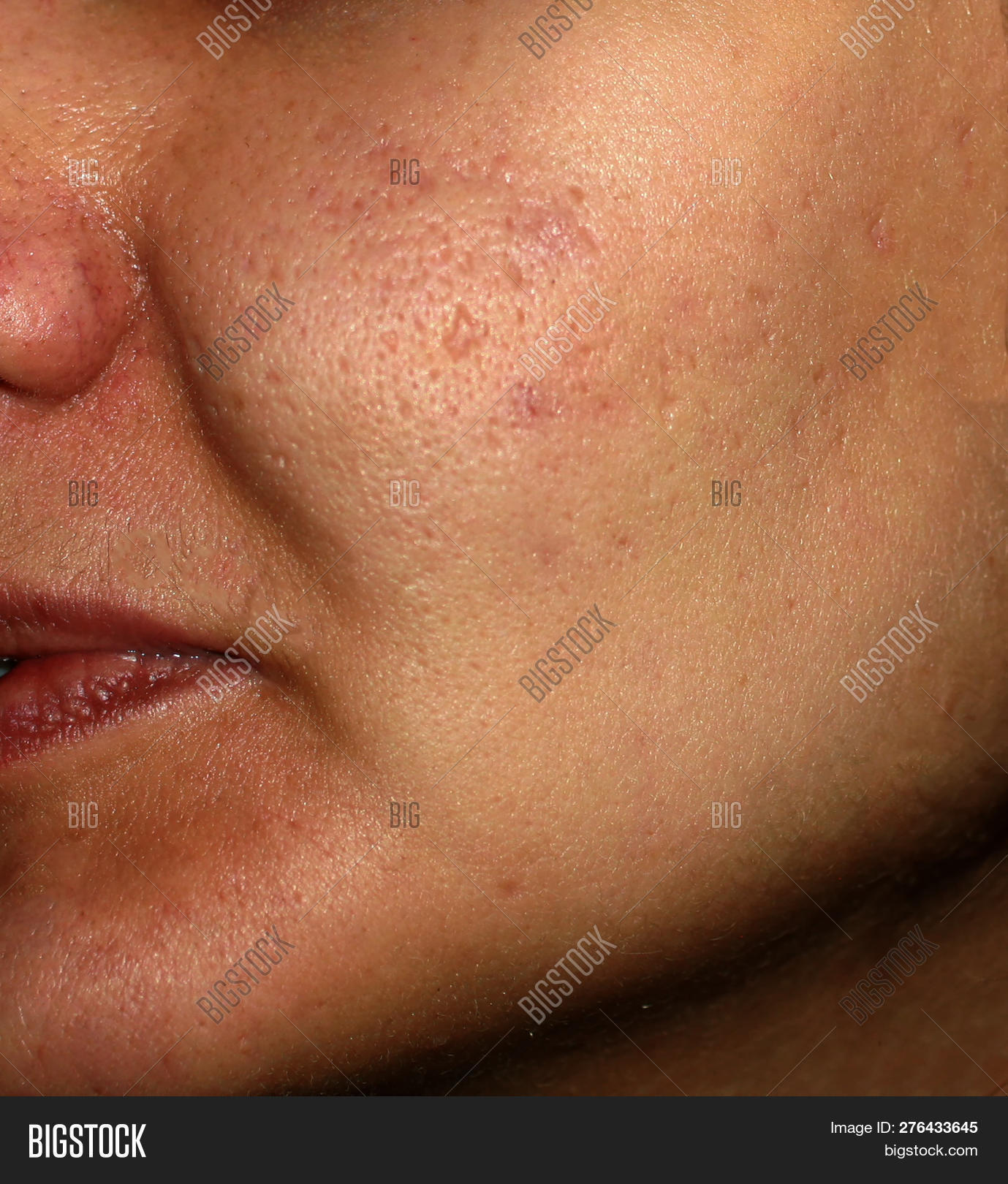 Inflamed Skin Face Image & Photo (Free Trial) | Bigstock