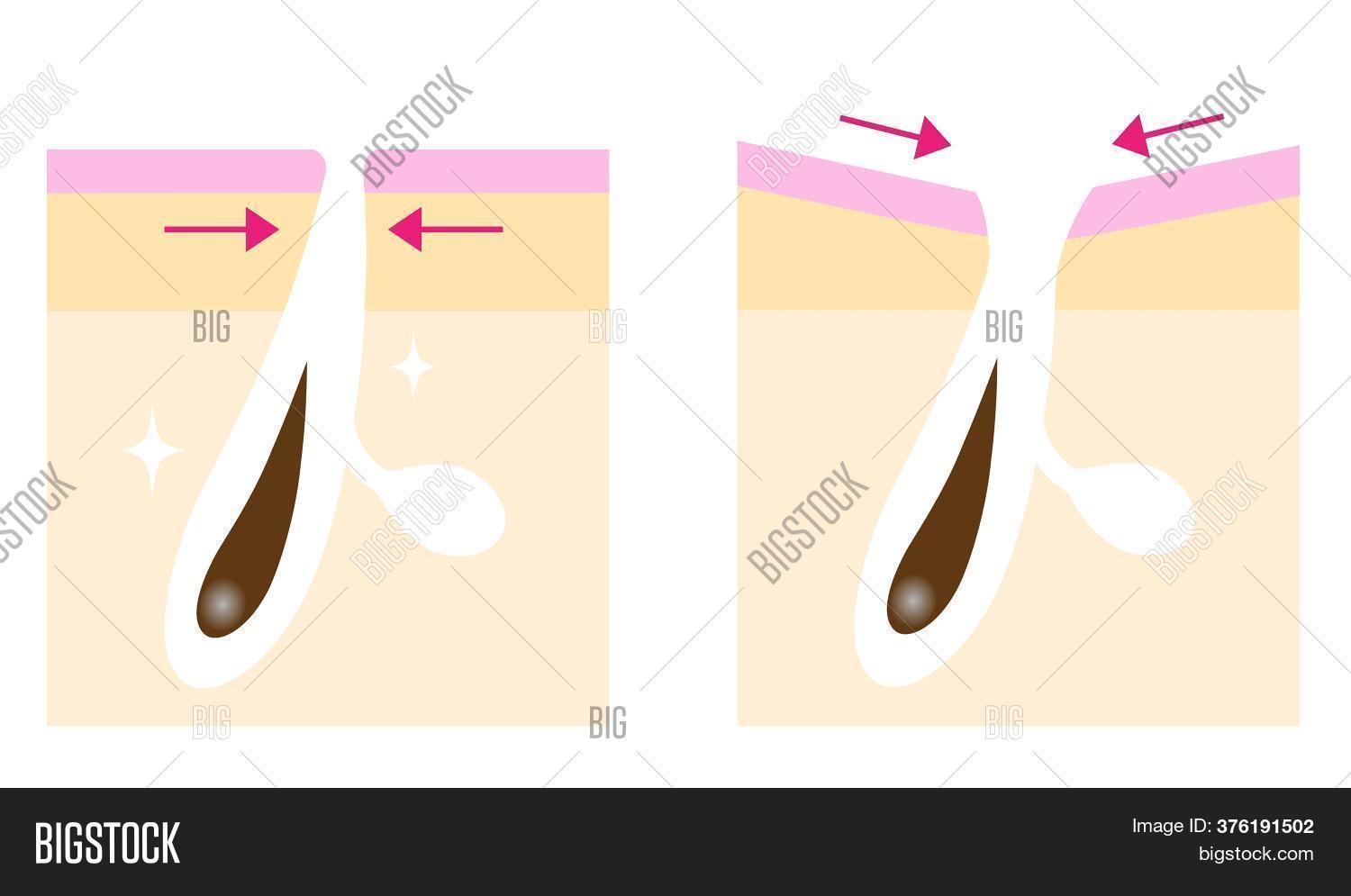 Skin Layer Sagging Image & Photo (Free Trial) | Bigstock