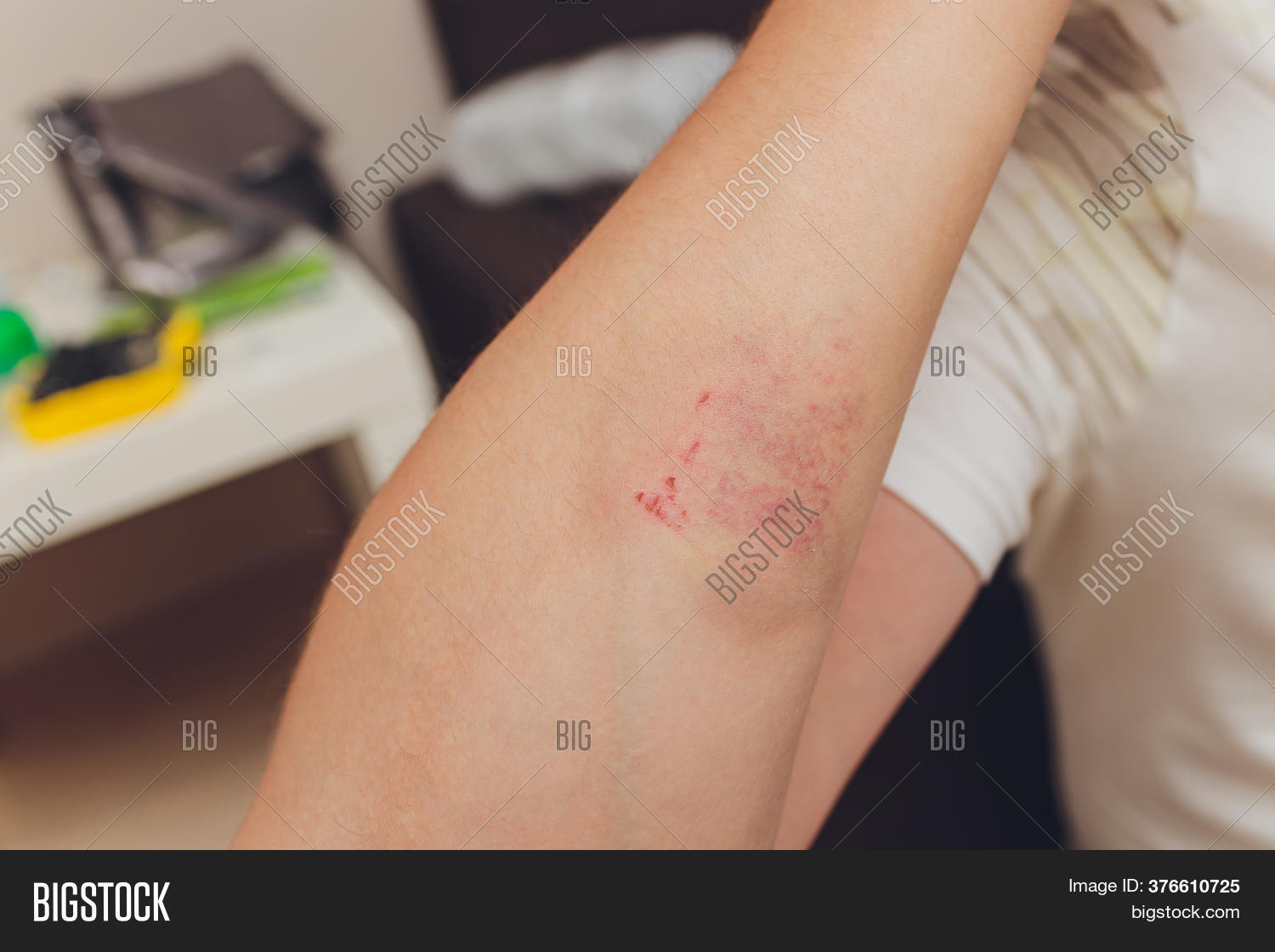 Abrasion On Underarm Image & Photo (Free Trial) | Bigstock