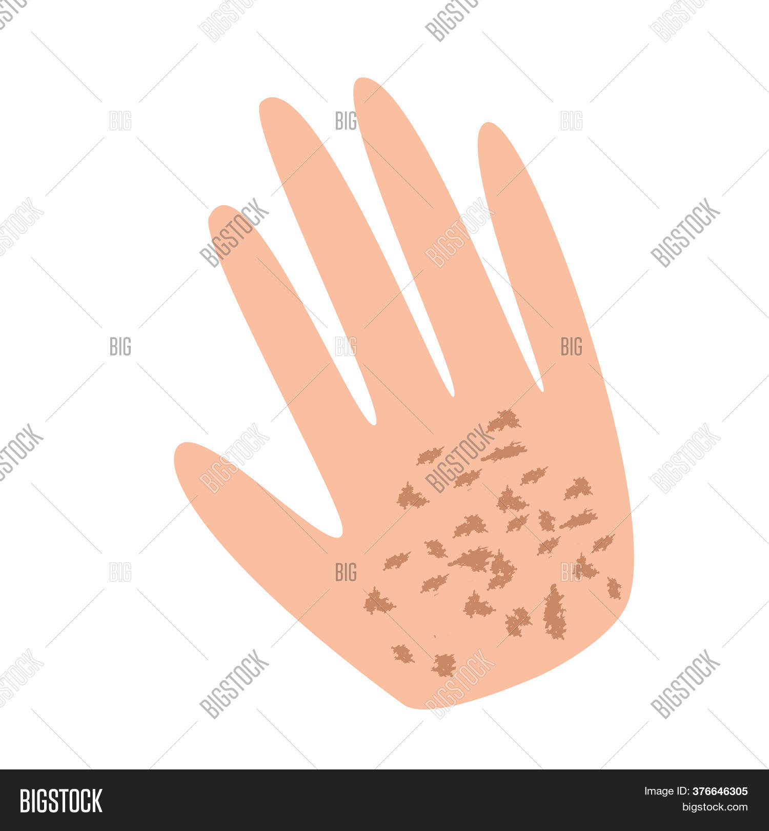 Freckles On Hand. Image & Photo (Free Trial) | Bigstock