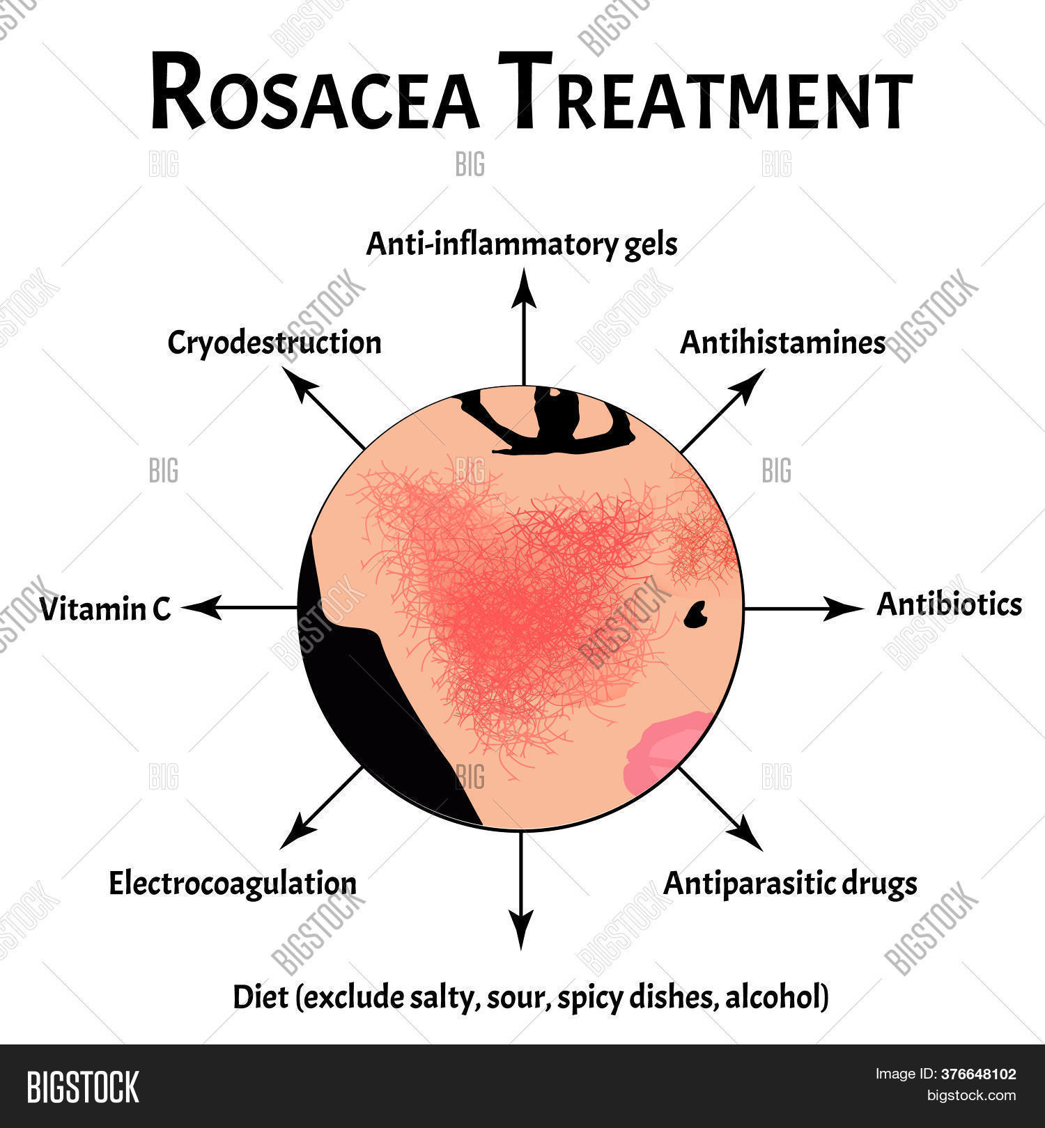 Causes Rosacea. Image & Photo (Free Trial) | Bigstock