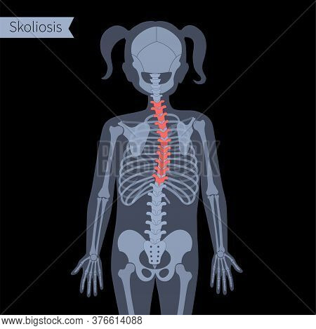 Thoracic Scoliosis Vector & Photo (Free Trial) | Bigstock