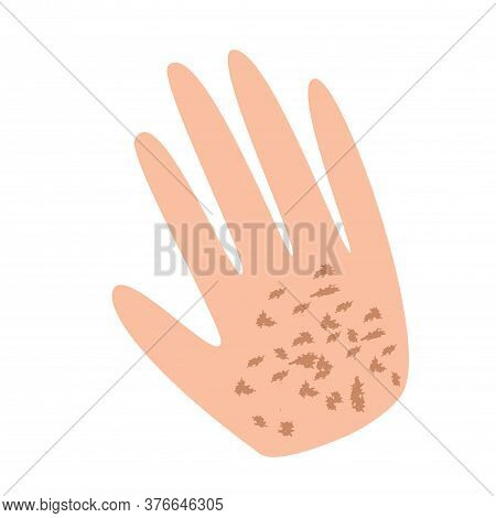 Freckles On Hand. Image & Photo (Free Trial) | Bigstock