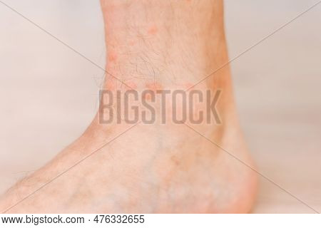 Close Allergic Rash Image & Photo (Free Trial) | Bigstock