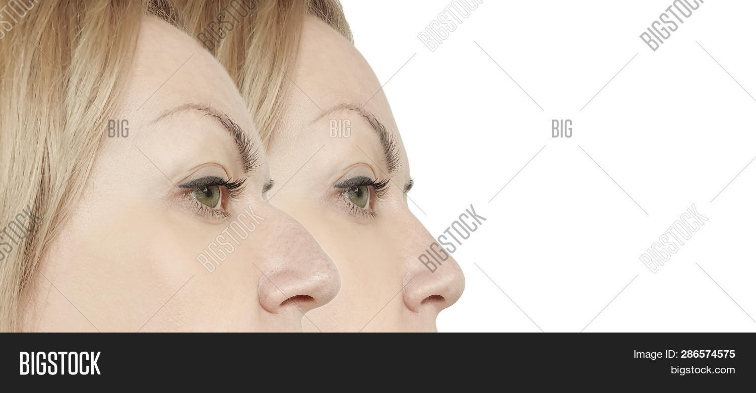 Female Nose Hump Image & Photo (Free Trial) | Bigstock
