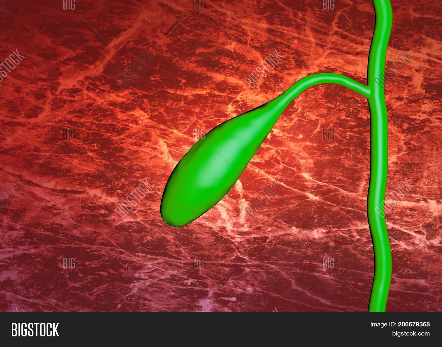Enlarged Gallbladder Image & Photo (Free Trial) | Bigstock