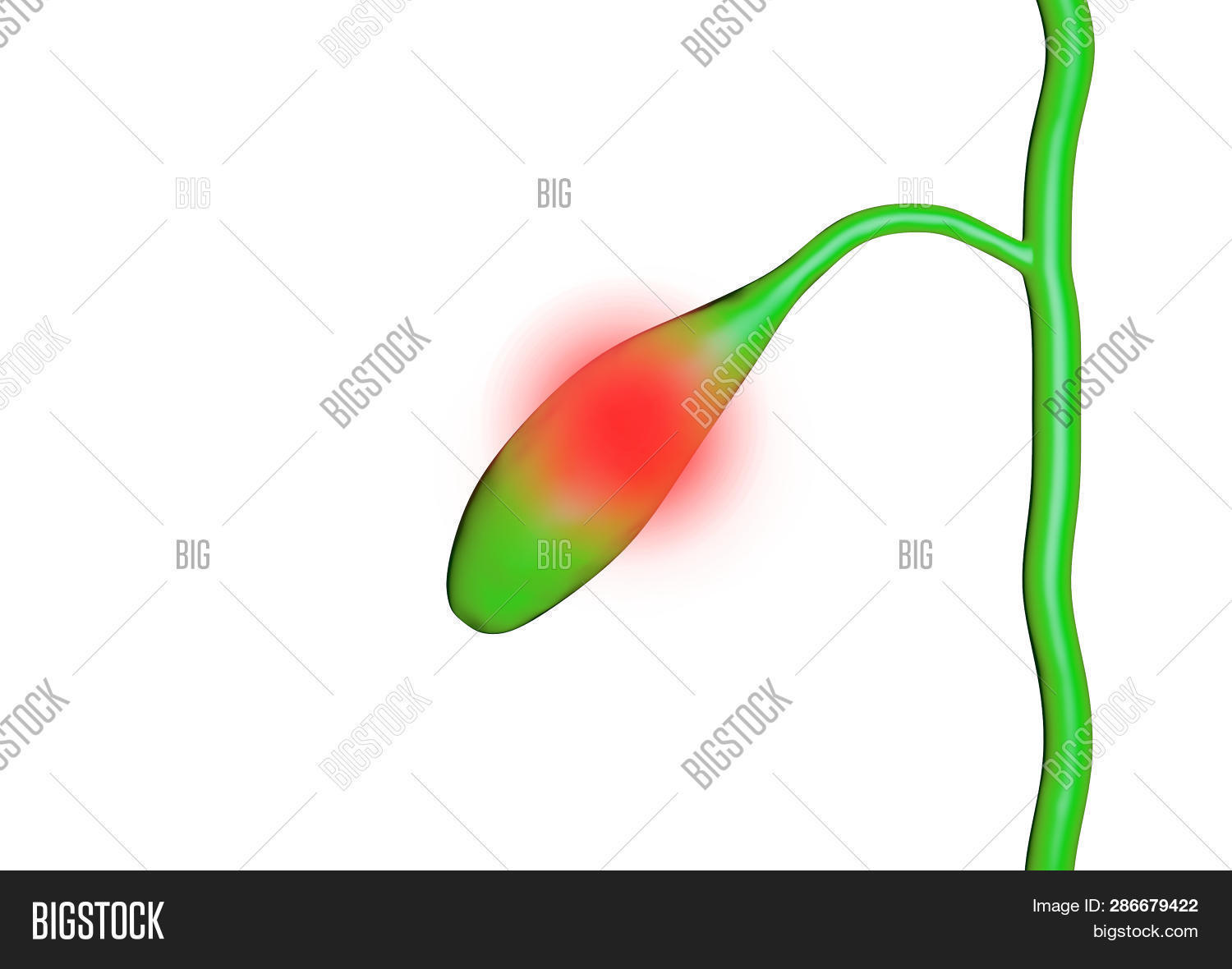 Enlarged Gallbladder Image & Photo (Free Trial) | Bigstock