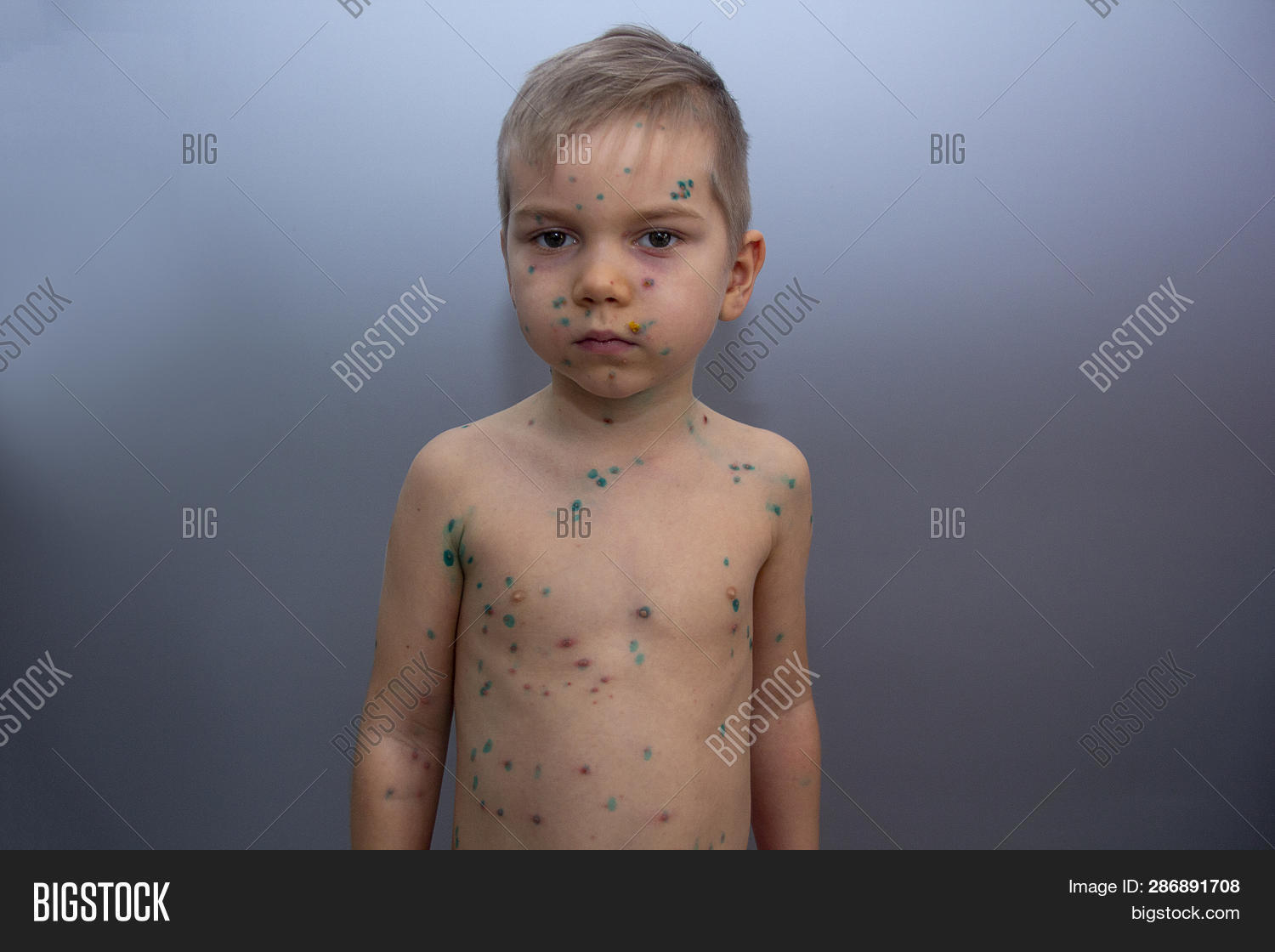 Sad Boy Chickenpox. Image & Photo (Free Trial) | Bigstock