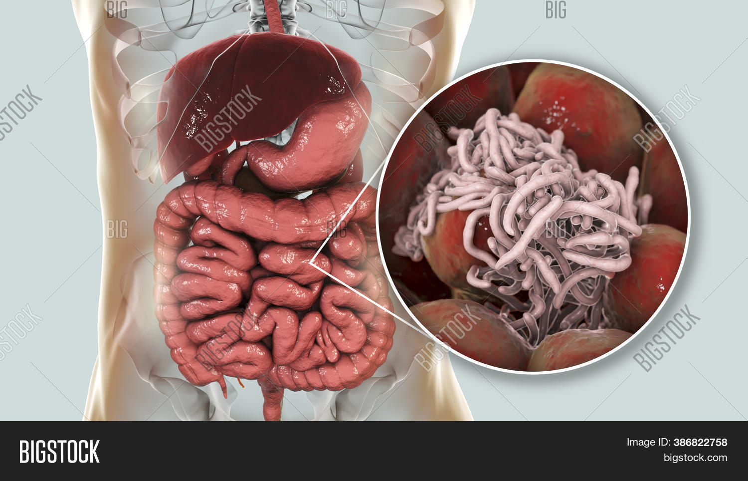 Parasitic Worms Human Image & Photo (Free Trial) | Bigstock