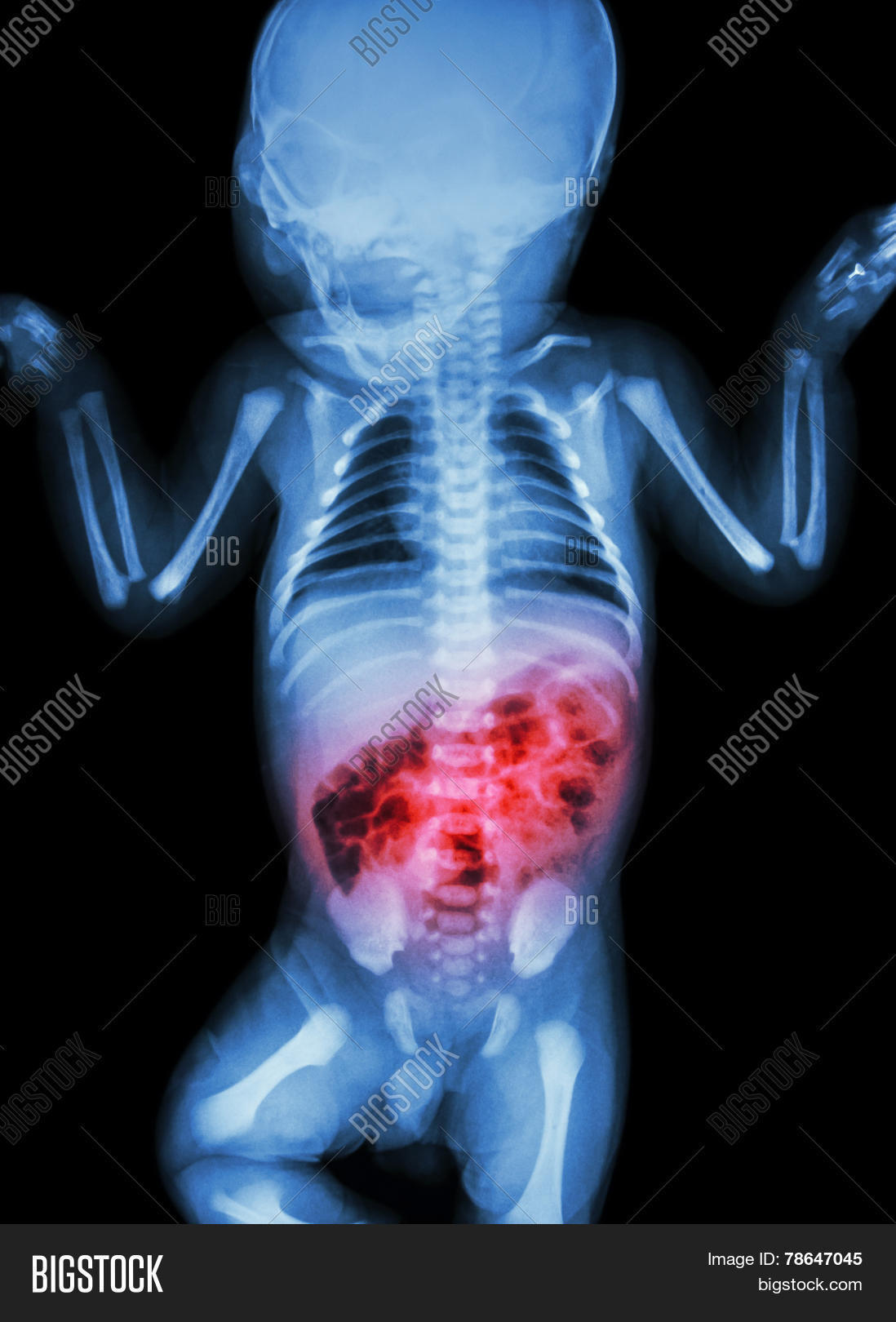 Enteritis (X-ray Sick Image & Photo (Free Trial) | Bigstock