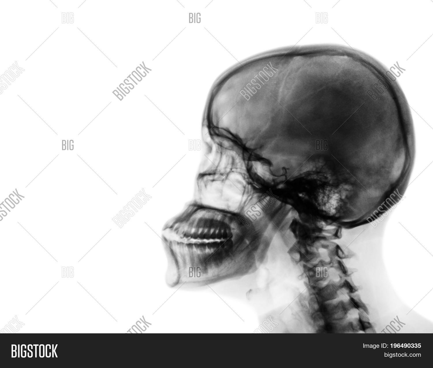 X-ray Normal Skull Image & Photo (Free Trial) | Bigstock