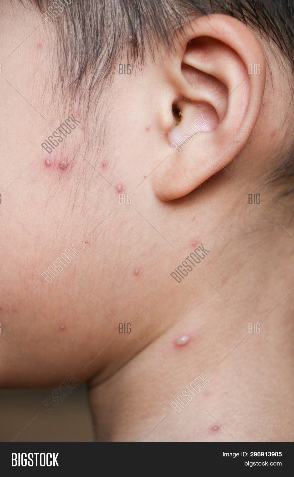 Chicken Pox Rash On Image & Photo (Free Trial) | Bigstock