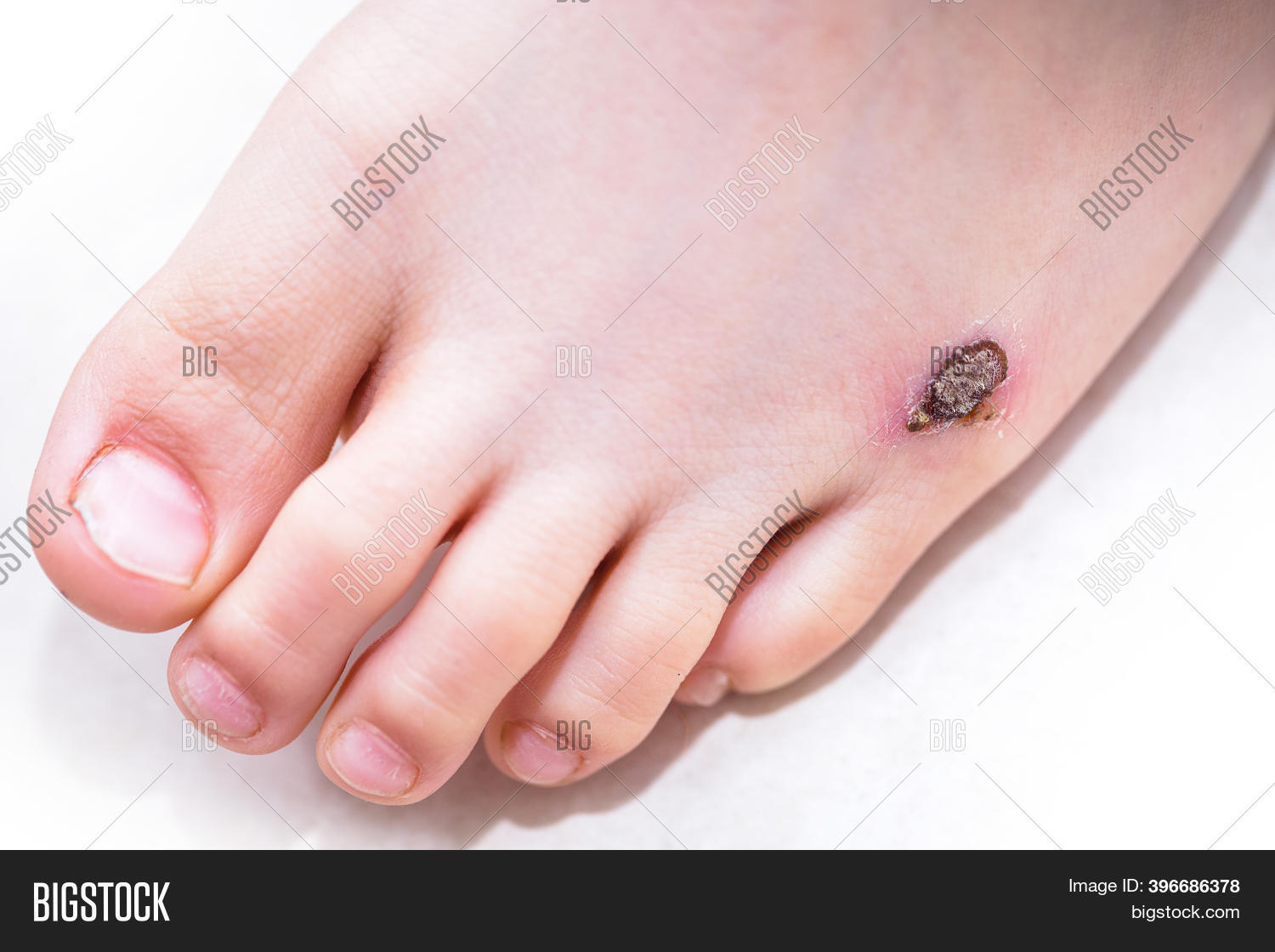 Pain Wound Boy's Foot Image & Photo (Free Trial) | Bigstock