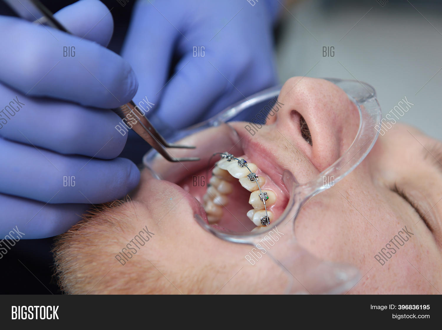 Installation Braces. Image & Photo (Free Trial) | Bigstock
