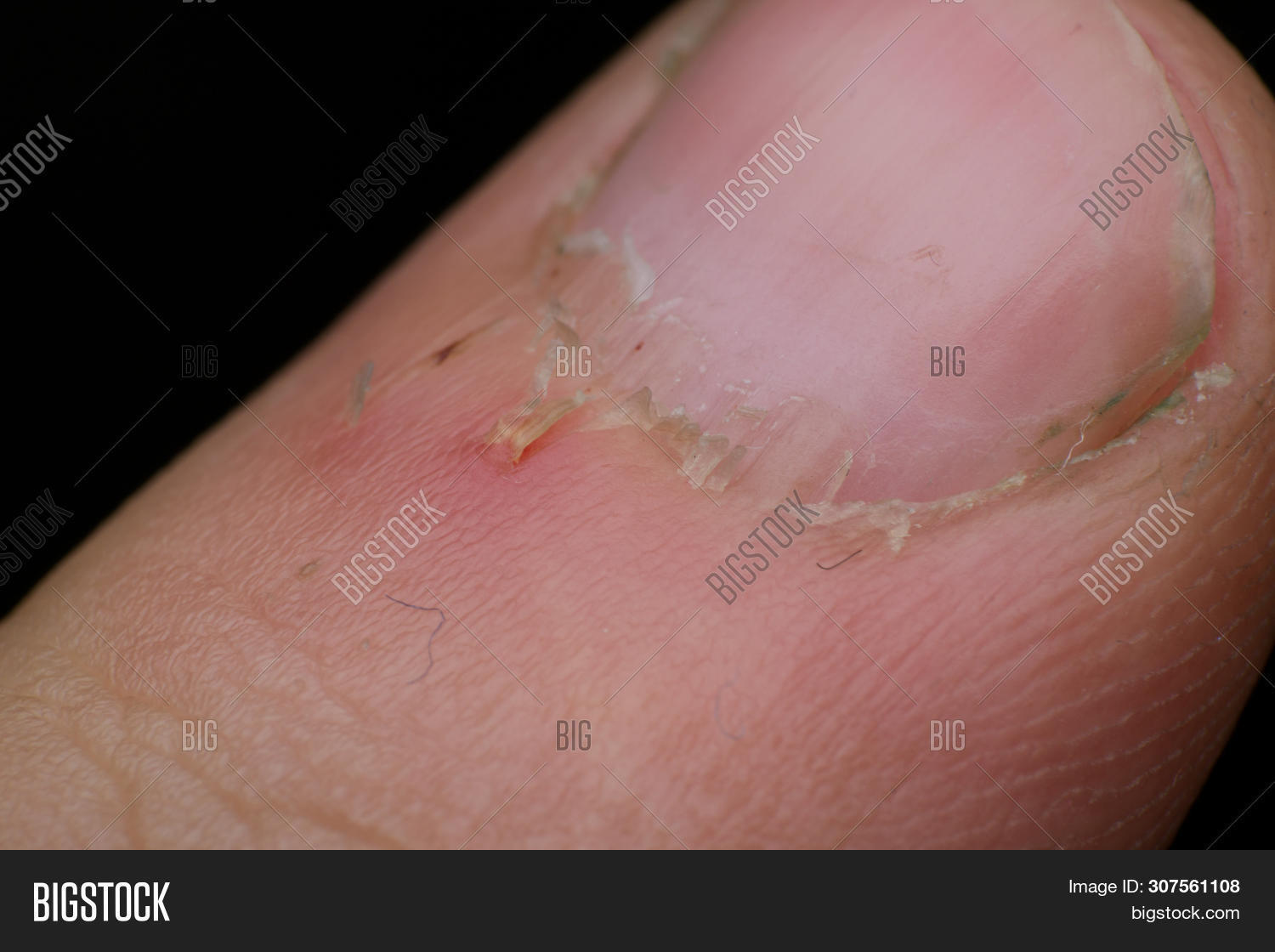 Chapped Skin Around Image & Photo (Free Trial) | Bigstock
