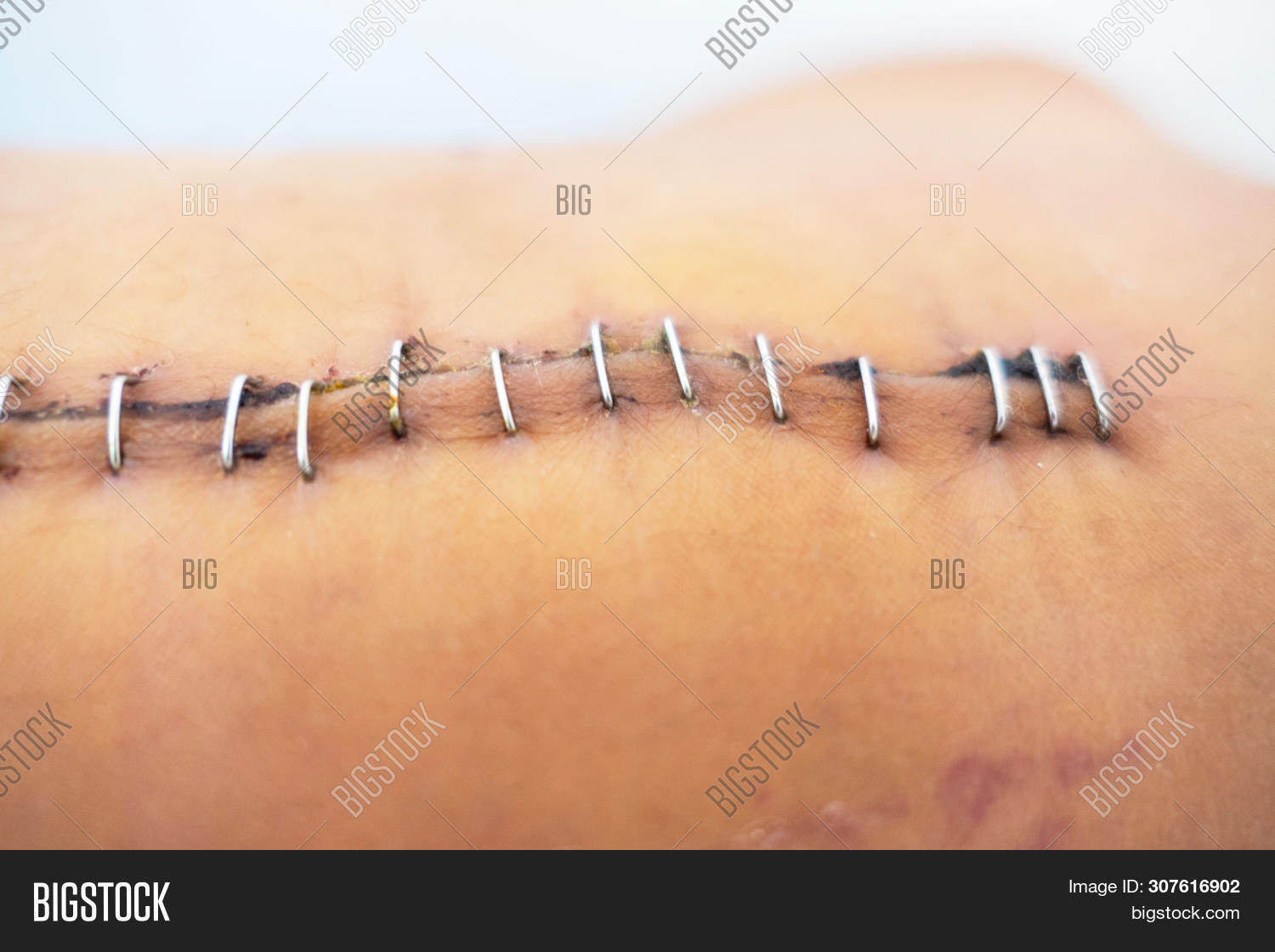 Wound Sutures Body Image & Photo (Free Trial) | Bigstock
