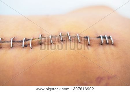 Wound Sutures Body Image & Photo (Free Trial) | Bigstock