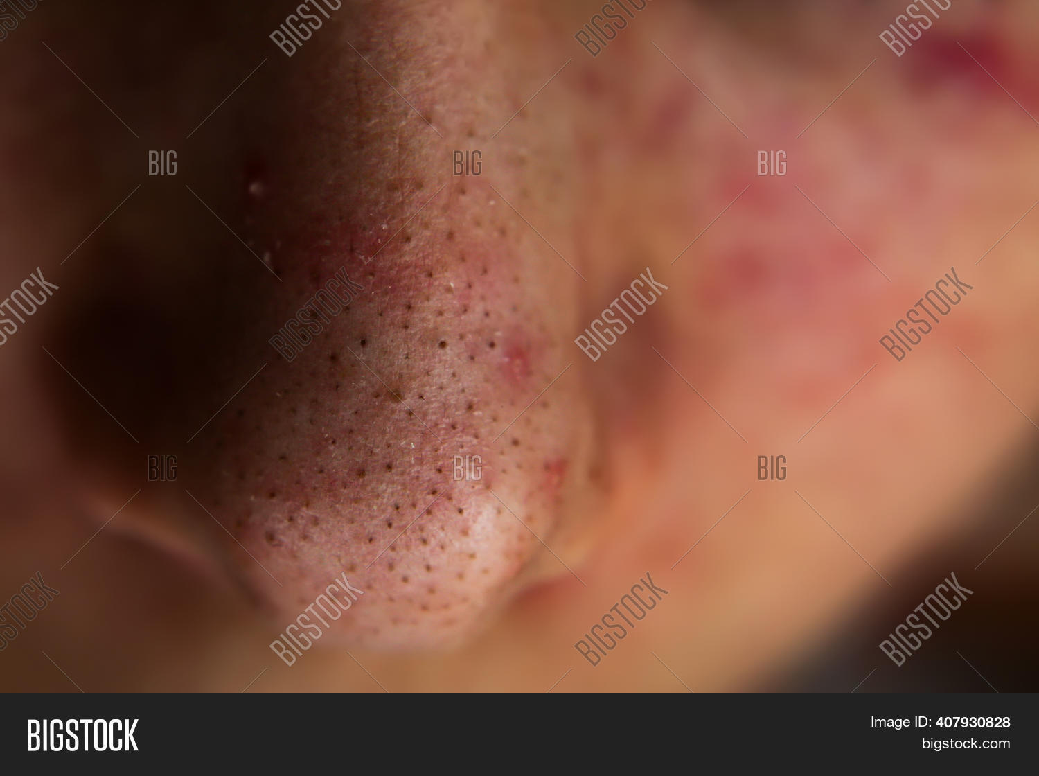 Closed- Pimple Image & Photo (Free Trial) | Bigstock