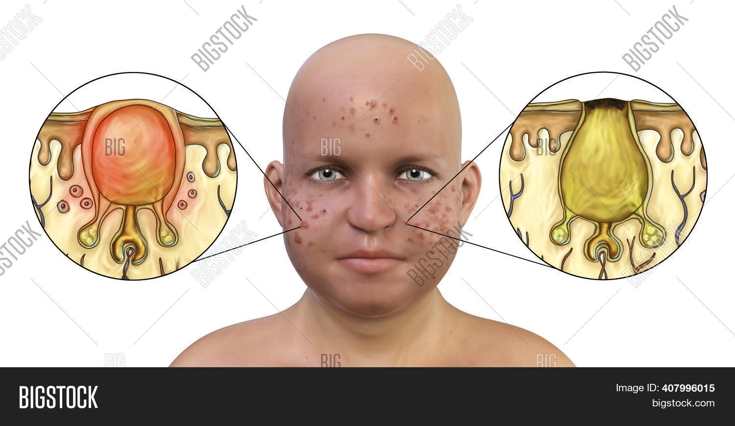 Acne Vulgaris Image & Photo (Free Trial) | Bigstock