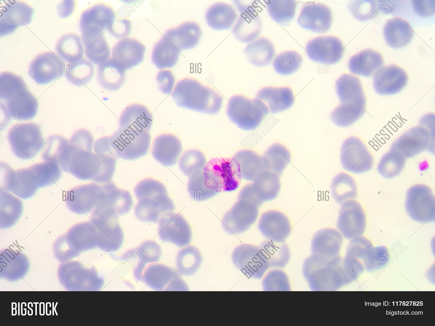 Blood Films Malaria Image & Photo (Free Trial) | Bigstock