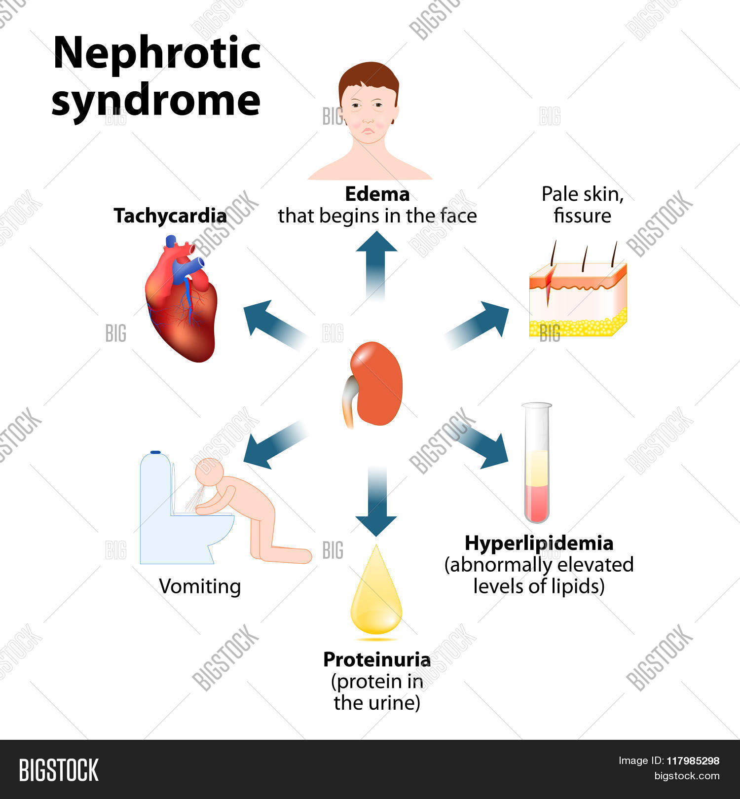 Nephrotic Syndrome Vector & Photo (Free Trial) | Bigstock