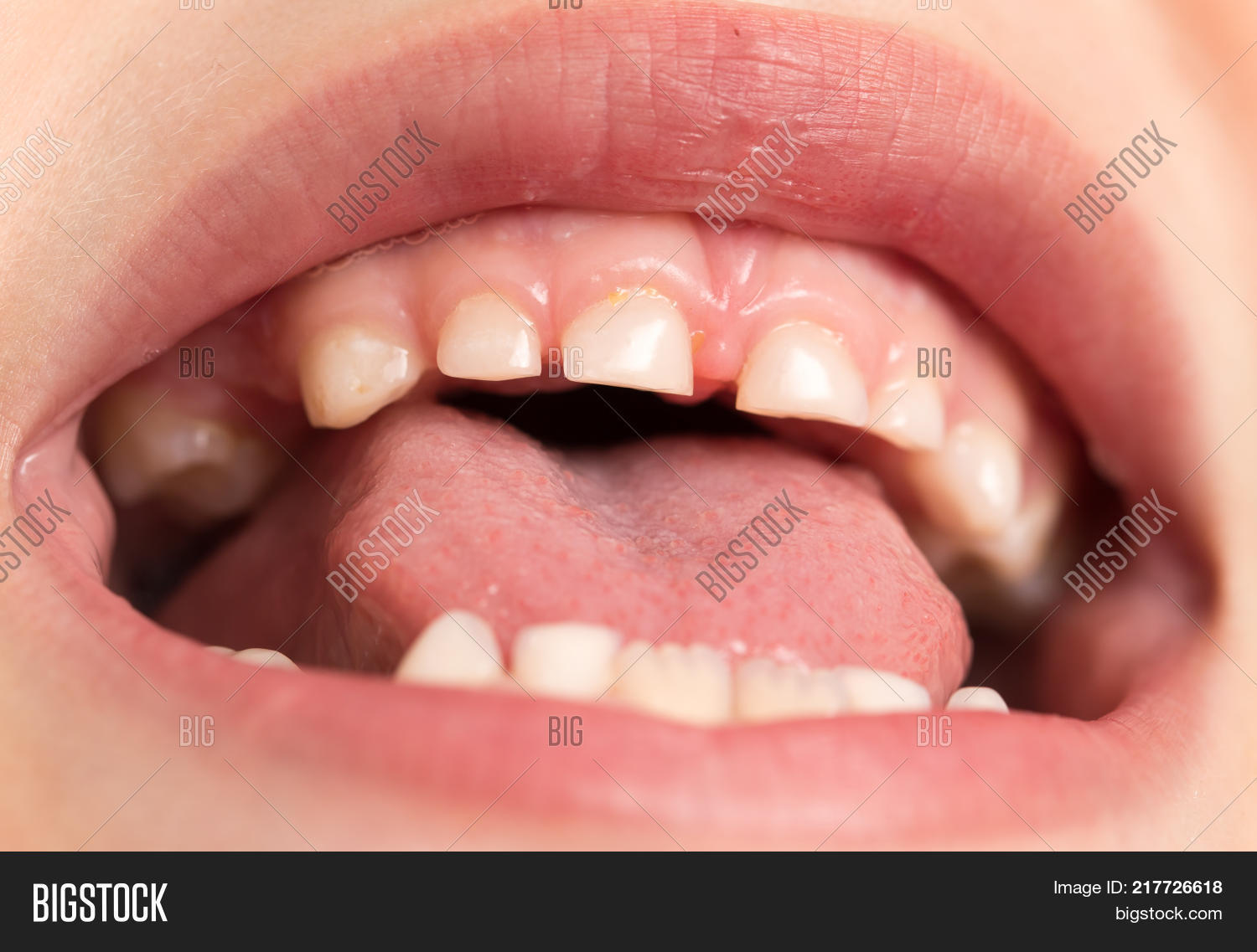 Baby Teeth. Macro . Image & Photo (Free Trial) | Bigstock