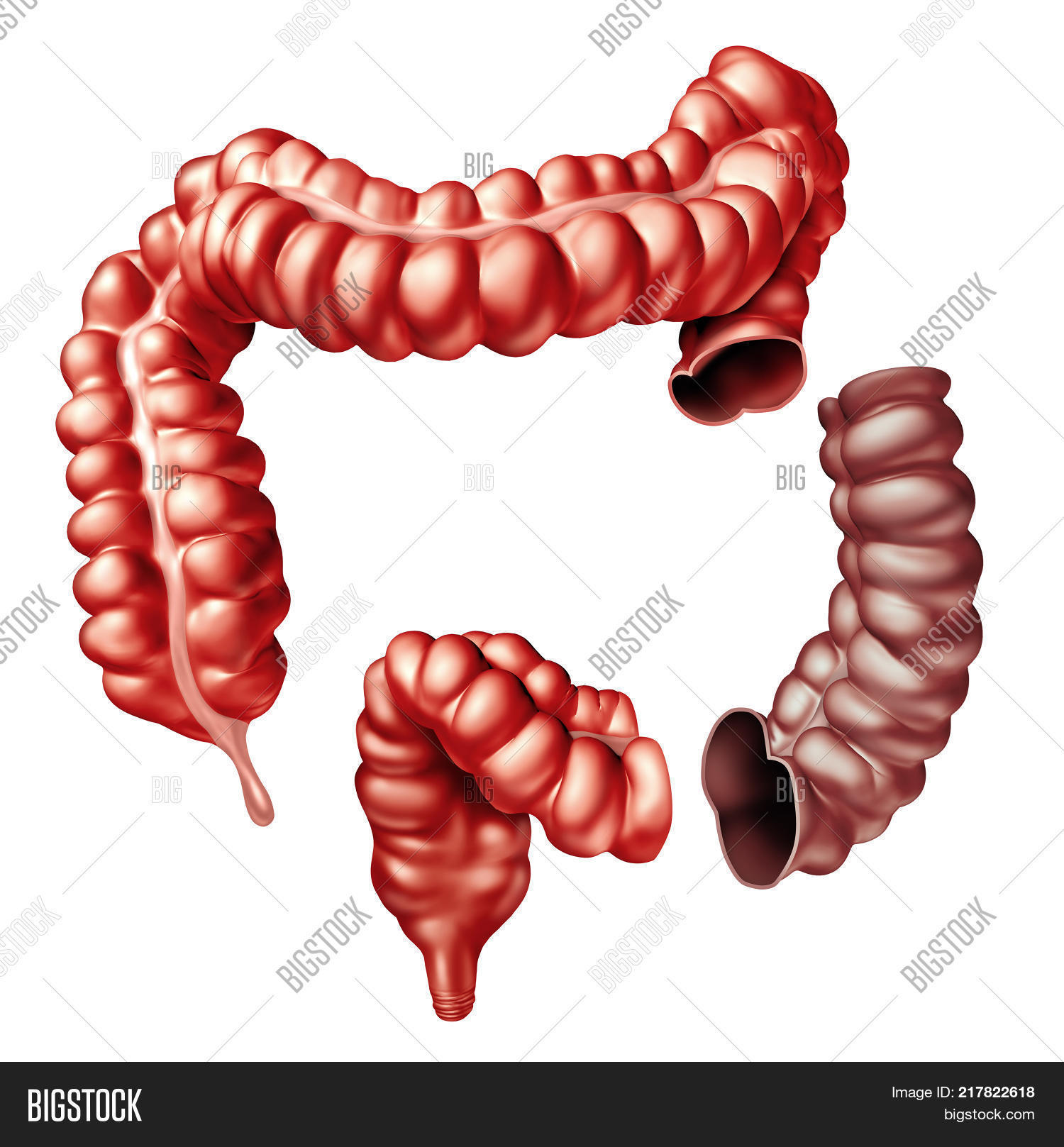 Colectomy Colon Image & Photo (Free Trial) | Bigstock