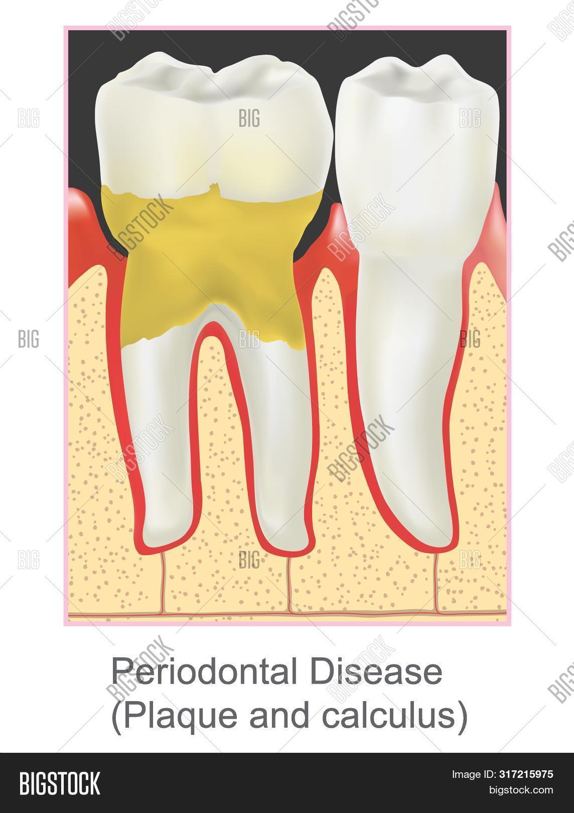 Dental Calculus Archaeology