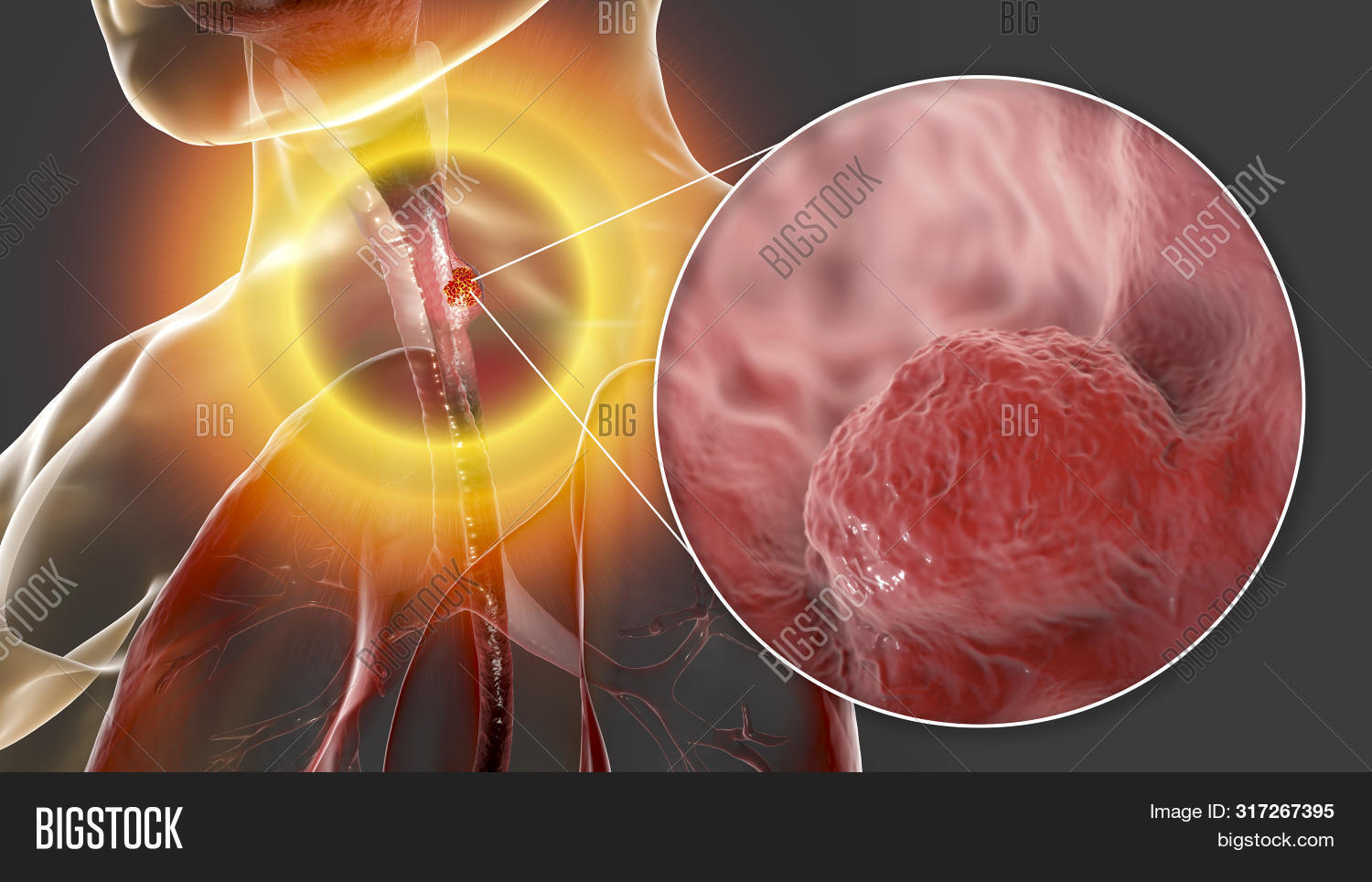 Esophageal Cancer, 3d Image & Photo (Free Trial) | Bigstock