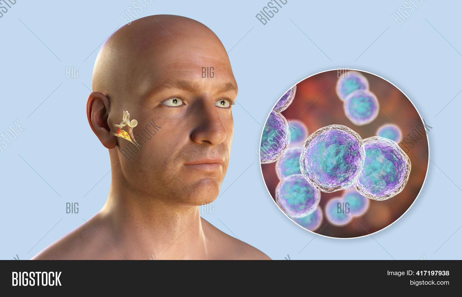 Moraxella Catarrhalis Image & Photo (Free Trial) | Bigstock