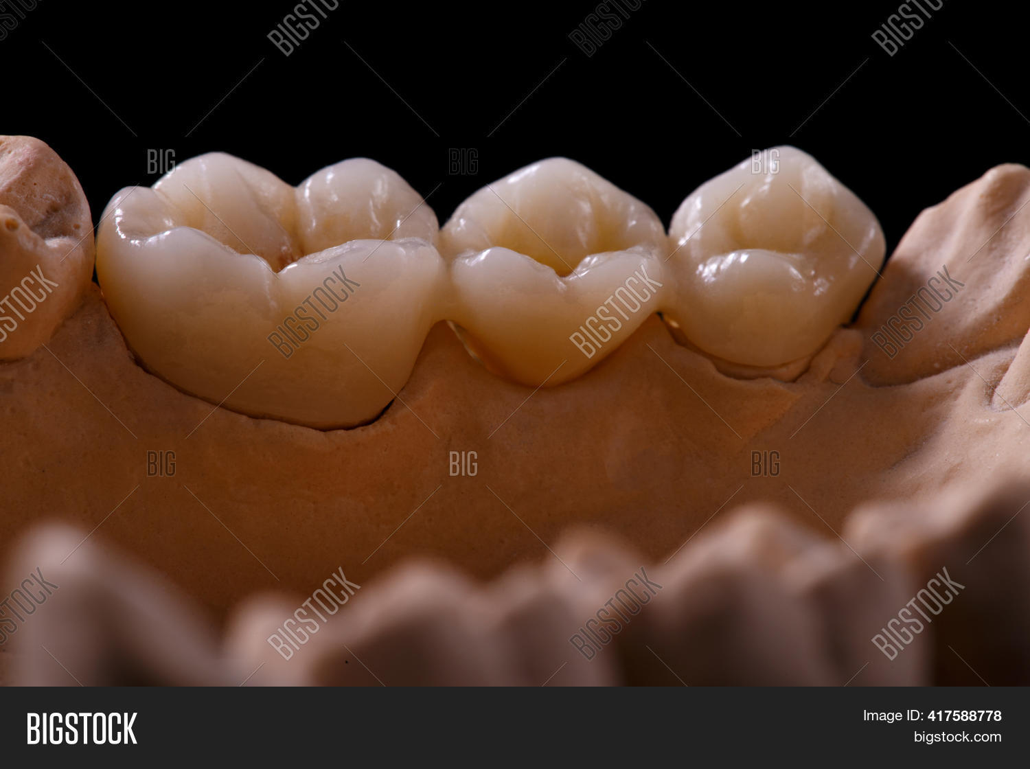 Mold Teeth. Gypsum Image & Photo (Free Trial) | Bigstock
