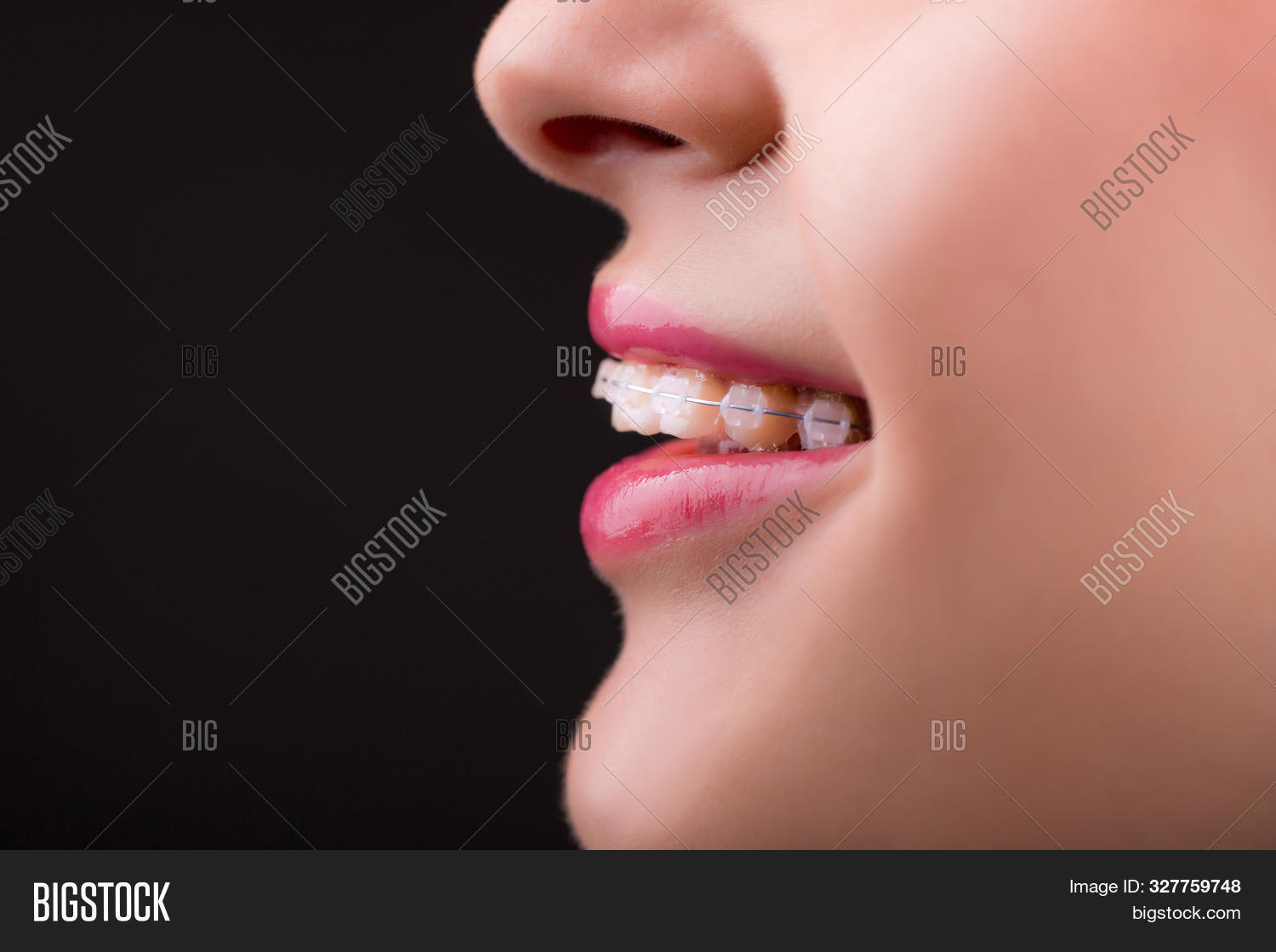 Braces Beautiful Image And Photo Free Trial Bigstock