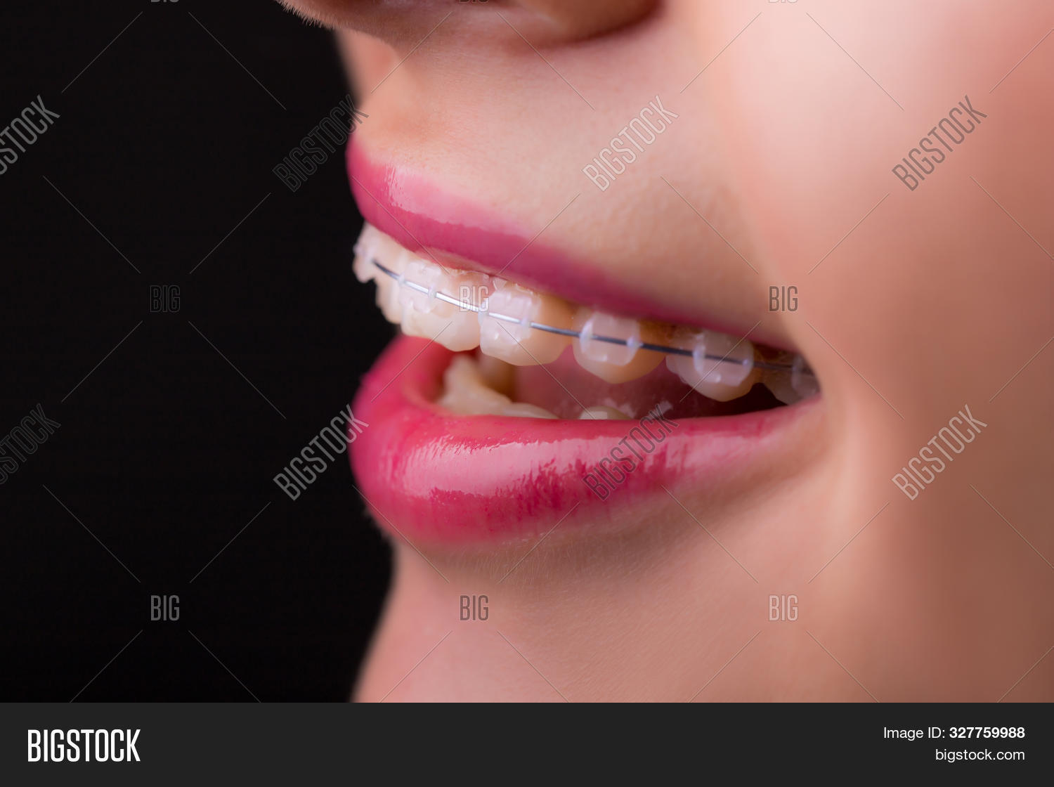 Braces Beautiful Image And Photo Free Trial Bigstock