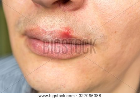 Red Inflammation Image & Photo (Free Trial) | Bigstock