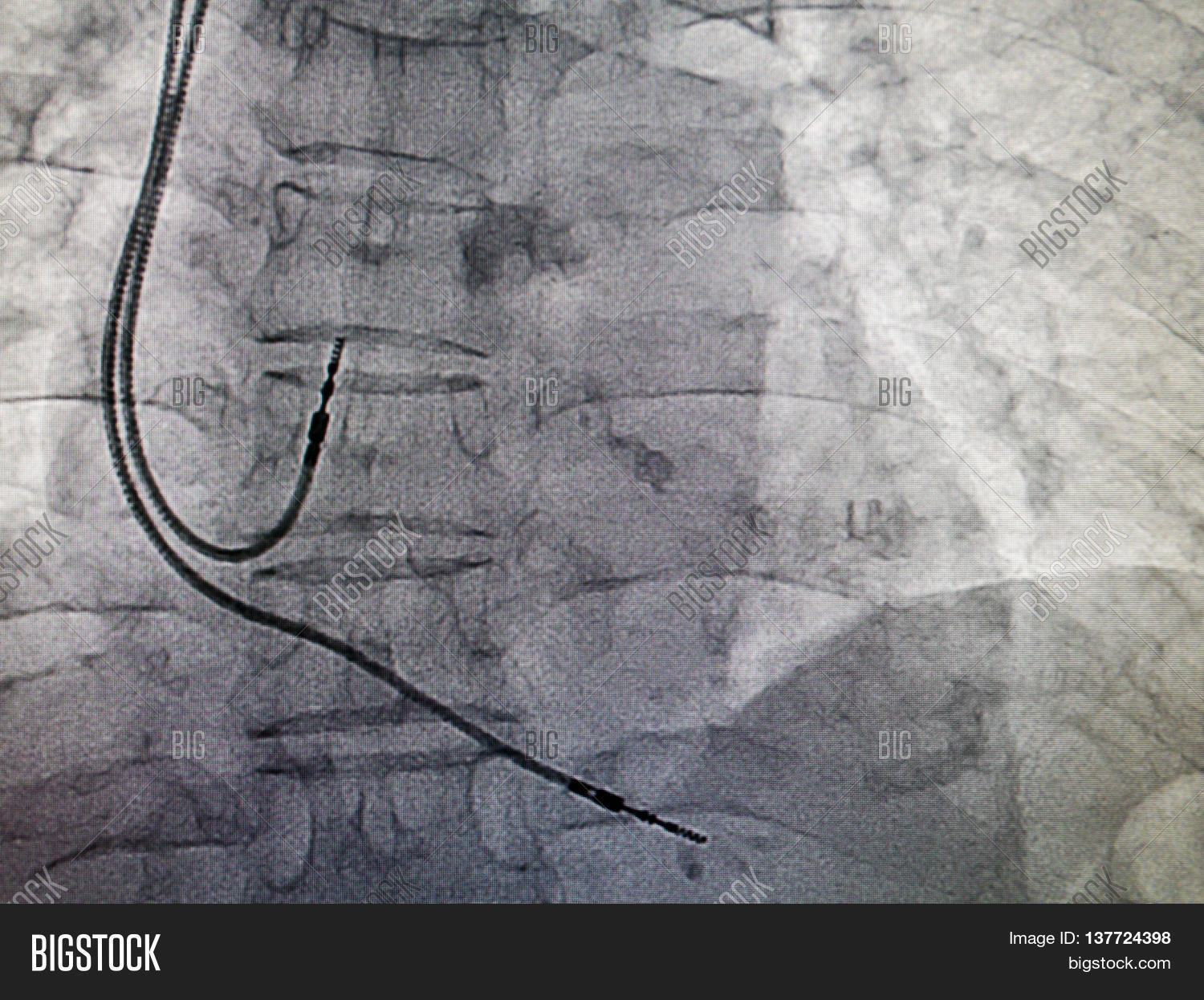 DDDR Pacemaker Cable X Image & Photo (Free Trial) | Bigstock