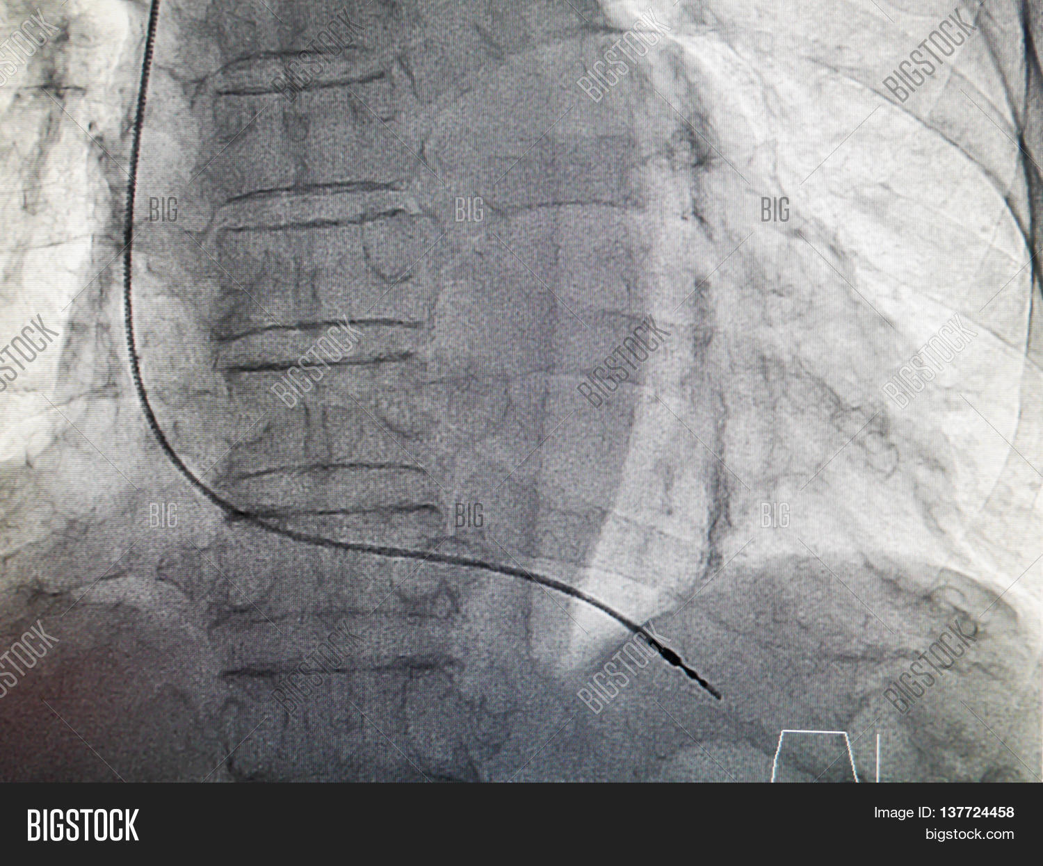 VVIR Pacemaker Cable X Image & Photo (Free Trial) | Bigstock