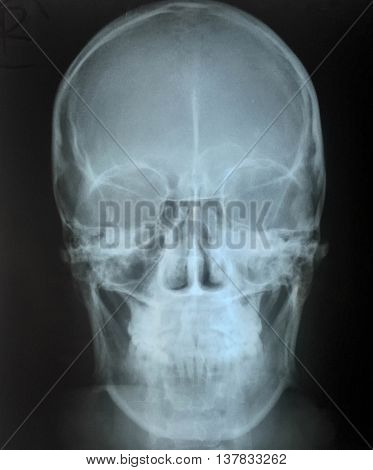 Skull AP View X-ray Image & Photo (Free Trial) | Bigstock