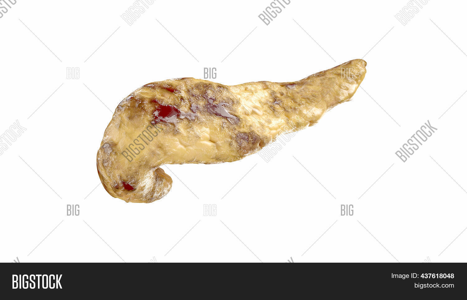 Pancreatitis Disease Image & Photo (Free Trial) | Bigstock