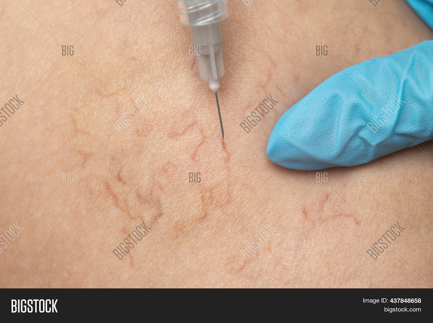 Removal Varicose Veins Image & Photo (Free Trial) | Bigstock